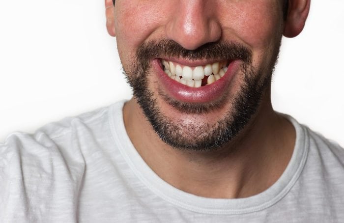 Smile Confidently with Dental Implants | Smile Viera